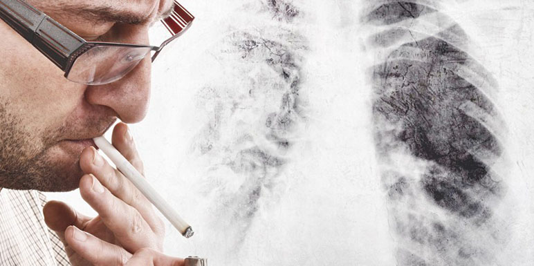 Emfizem pluća – simptomi i terapija - Ordinacija.tv