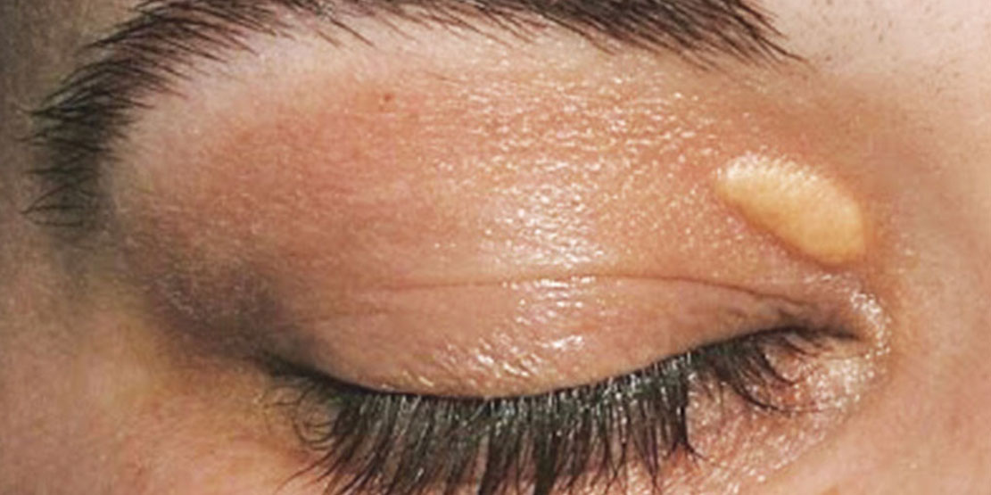 Masne naslage oko očiju: Zašto nastaju i kako se uklanjaju? - Ordinacija.tv