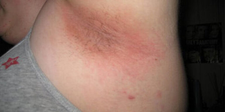 Šest bolesti koje izazivaju CRVENILO NA PREPONAMA I PAZUHU – Simptomi i ...